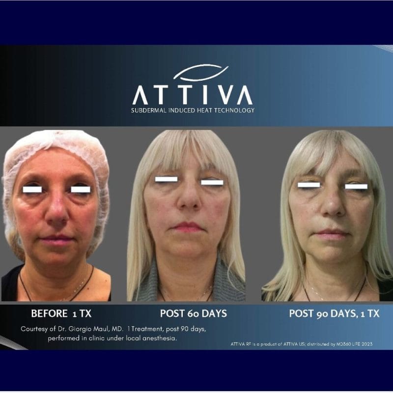 Attiva IRF Skin Tightening | Non-Surgical Rejuvenation in York & Timonium